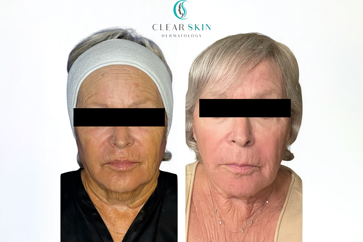 Laser Skin Resurfacing in Clearwater, FL | Clear Skin Dermatology